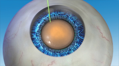 LENSAR Laser System - Price Vision Group