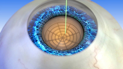 LENSAR Laser System - Price Vision Group