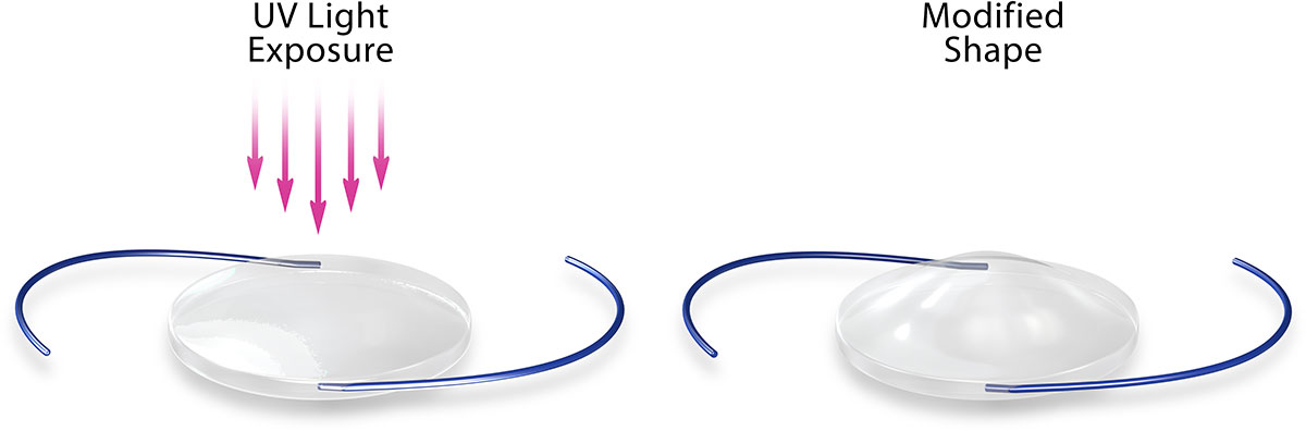 Light Adjustable Lens for Cataract Surgery in Indianapolis | Price Vision Group